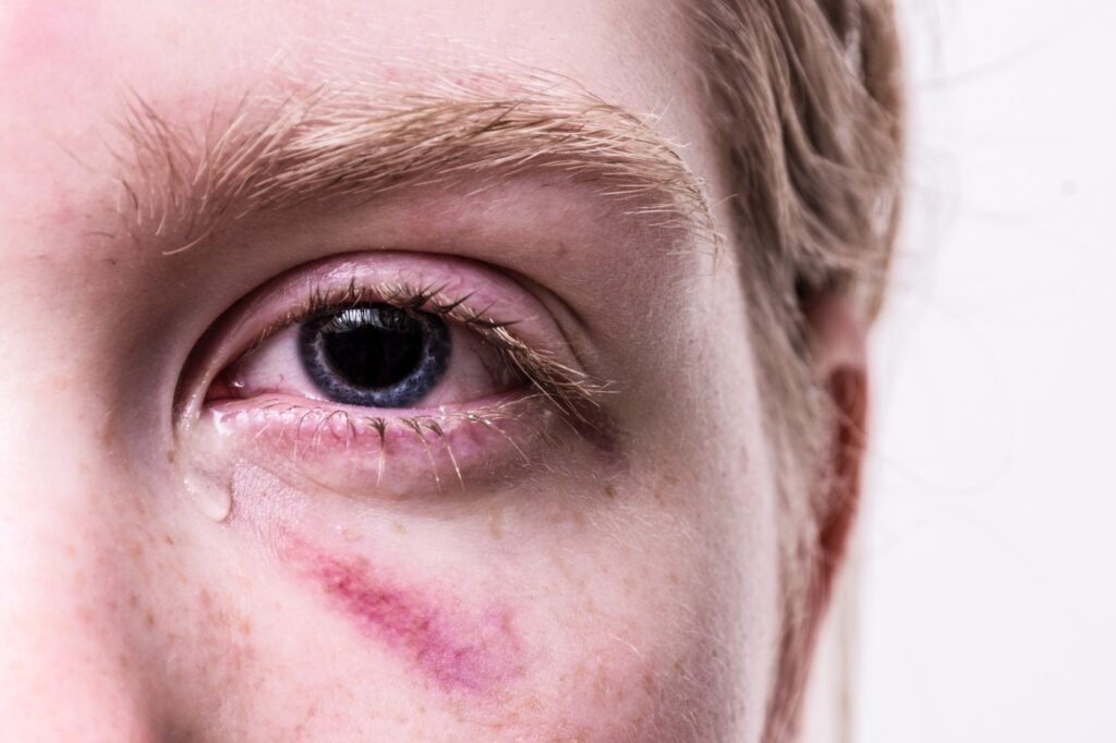 Were Your Eyes Injured on the Job? Read This Guide to Worker's Comp