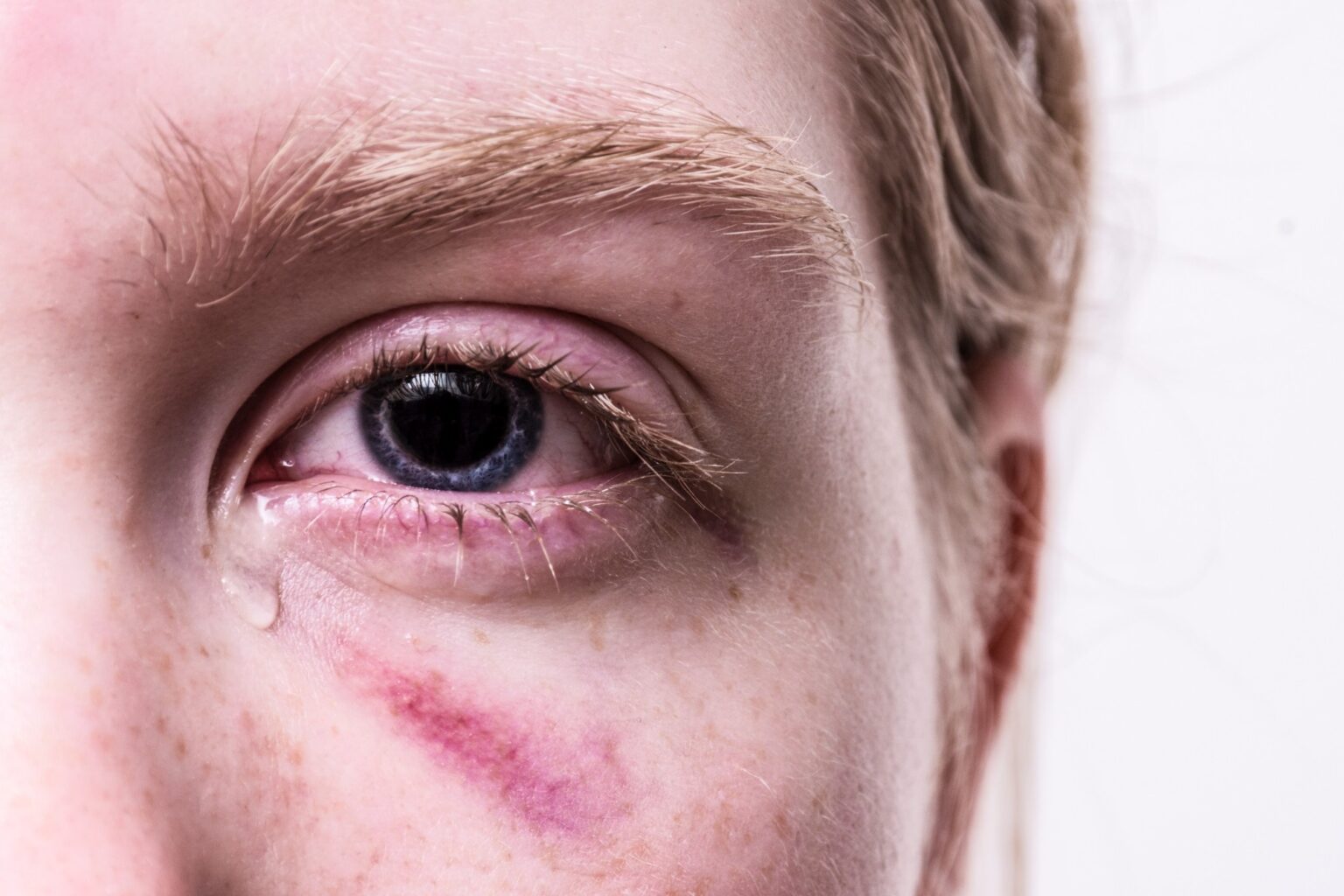 Were Your Eyes Injured on the Job? Read This Guide to Worker's Comp